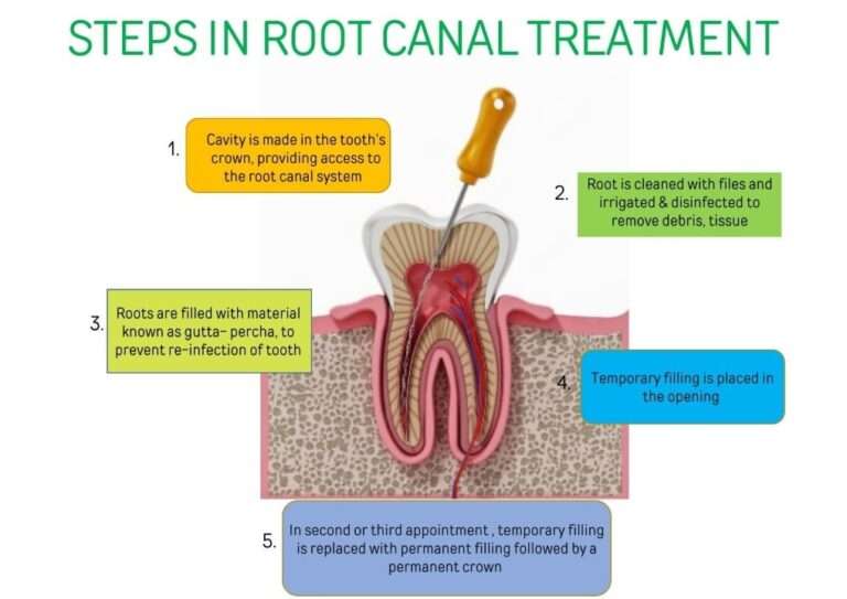 Root Canal Treatment Steps | Crossroads Dental Clinic Dubai