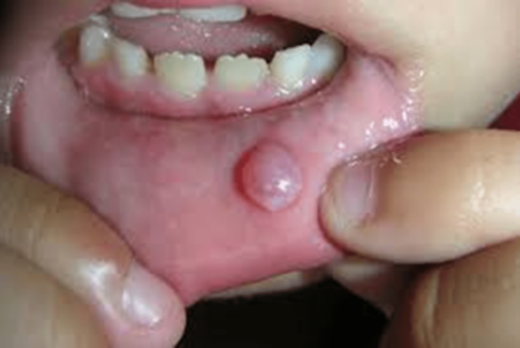 Oral Mucocele: Causes, Symptoms & Effective Treatment Options