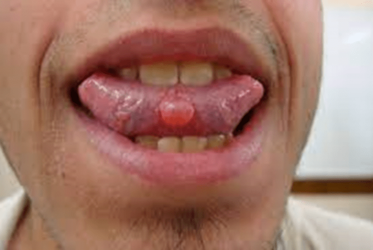 Oral Mucocele: Causes, Symptoms & Effective Treatment Options