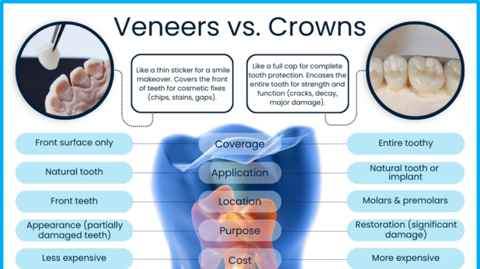 Veneers vs Crowns: Key Differences & Which Is Best for You